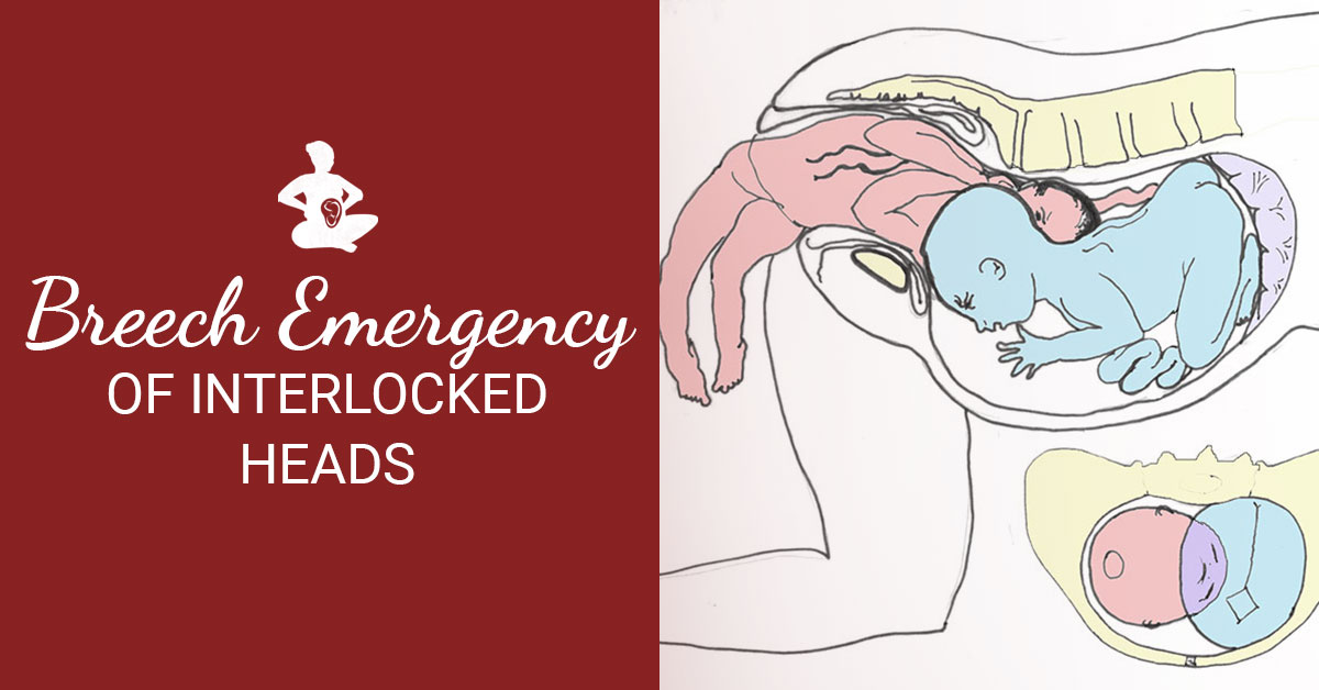 Breech Emergency of Interlocked Heads - Spinning Babies